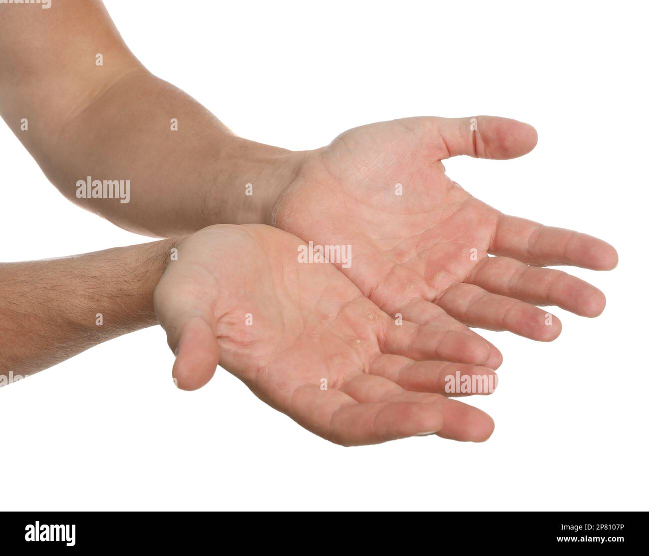 Man suffering from calluses on hands against white background, closeup ...