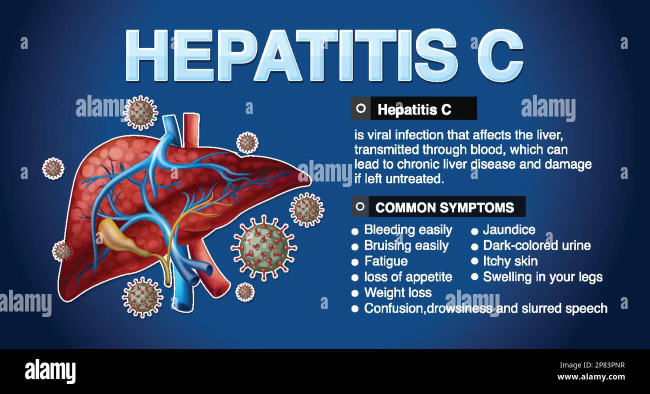 Symptoms of Hepatitis C Infographic illustration Stock Vector Image & Art - Alamy