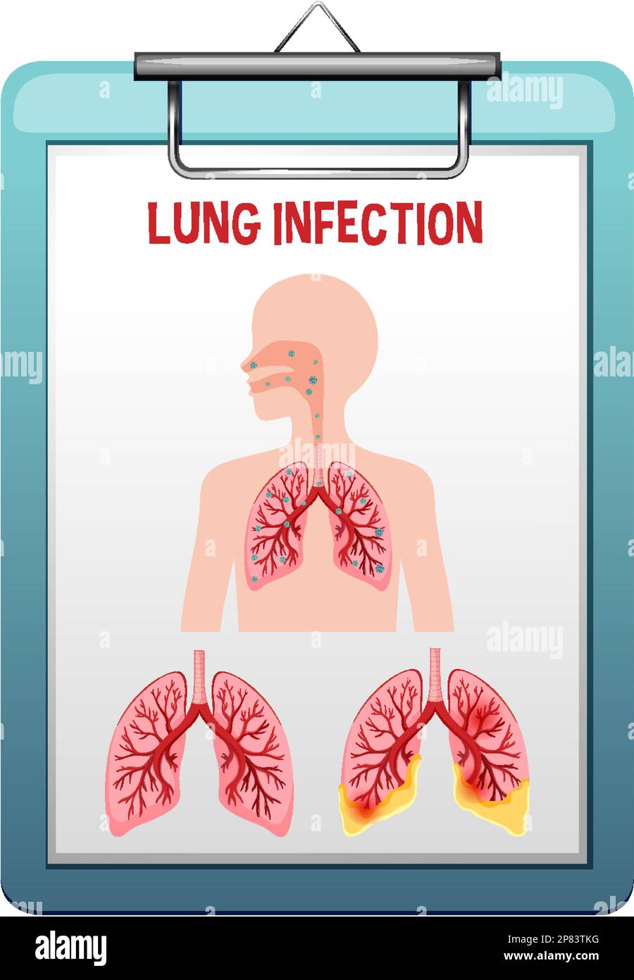 Lung infection pneumonia vector illustration Stock Vector Image & Art ...