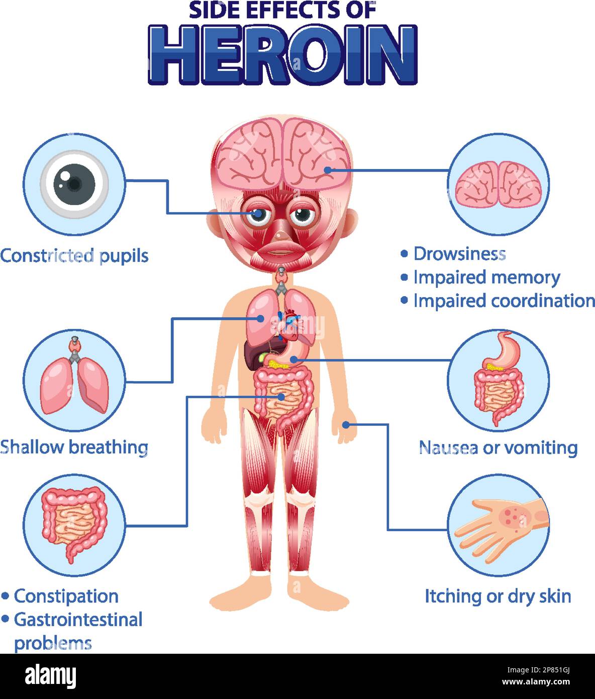 Human anatomy diagram cartoon style of Heroin side effects illustration ...