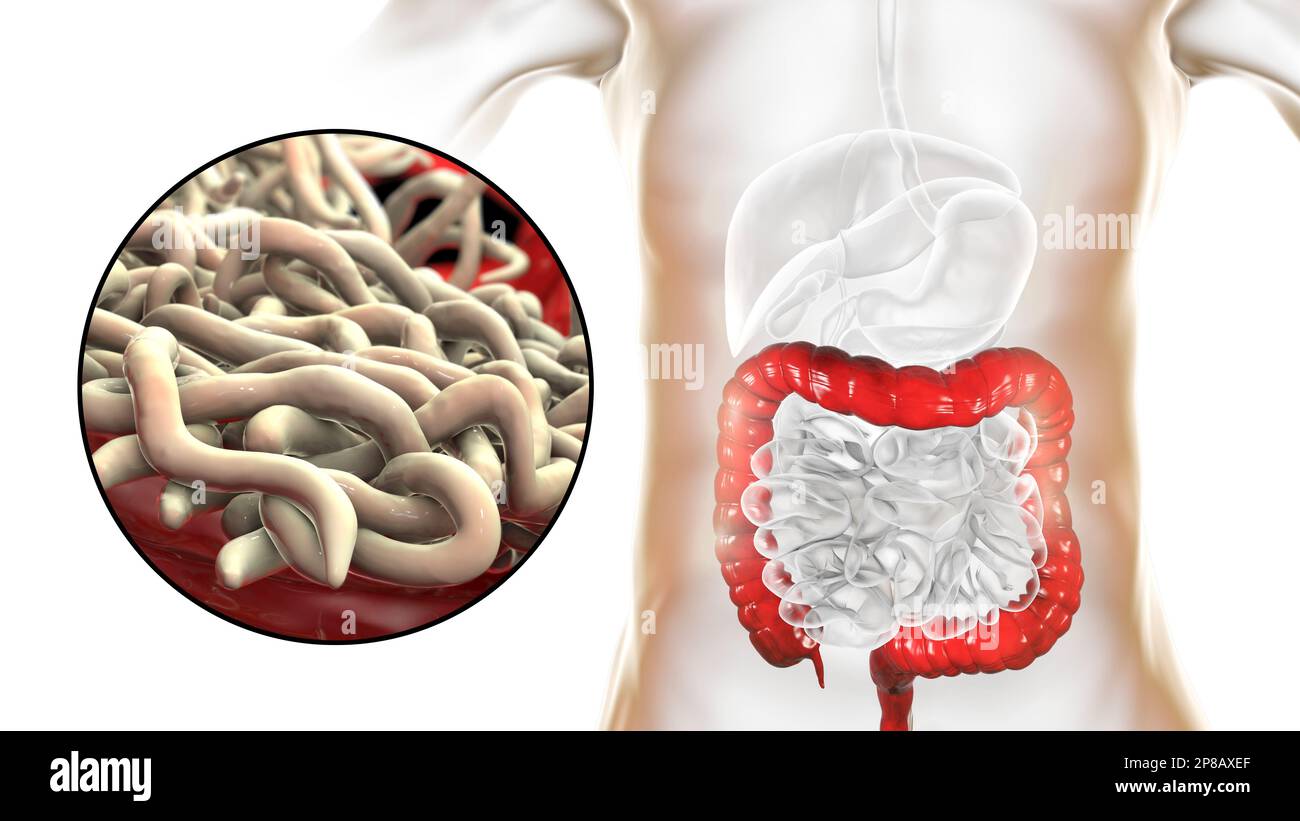Enterobius vermicularis hi-res stock photography and images - Alamy