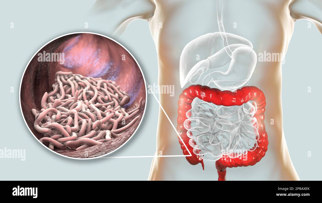 Enterobius vermicularis hi-res stock photography and images - Alamy