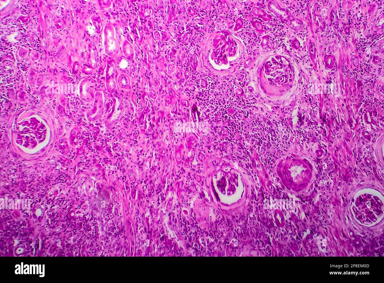 Acute glomerulonephritis hi-res stock photography and images - Alamy