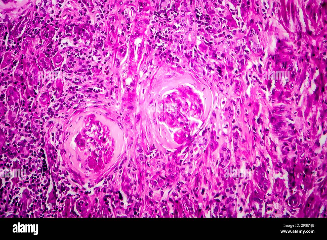 Acute glomerulonephritis hi-res stock photography and images - Alamy