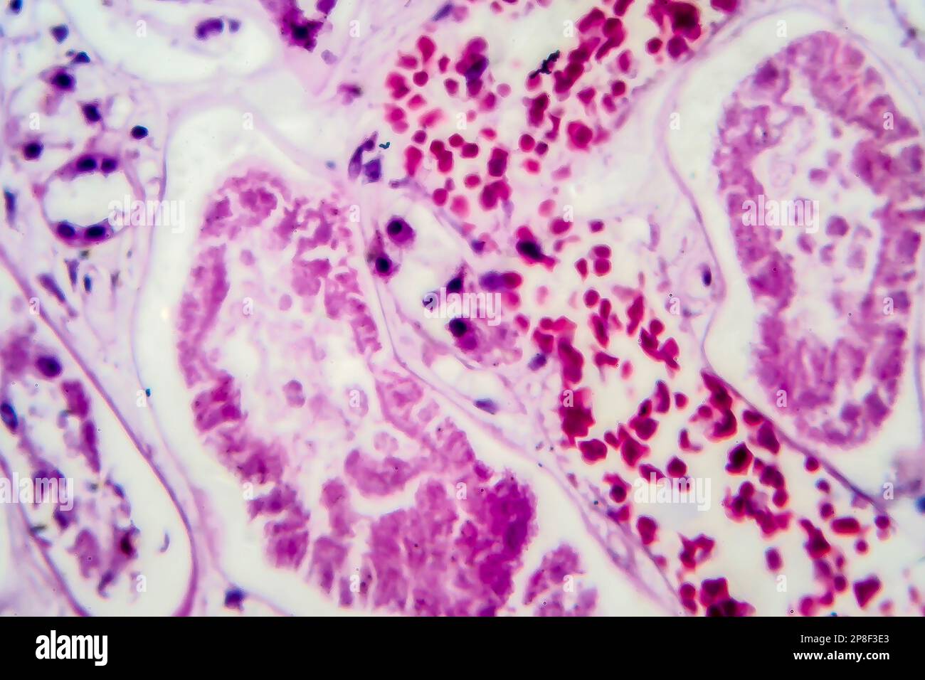 Acute glomerulonephritis hi-res stock photography and images - Alamy