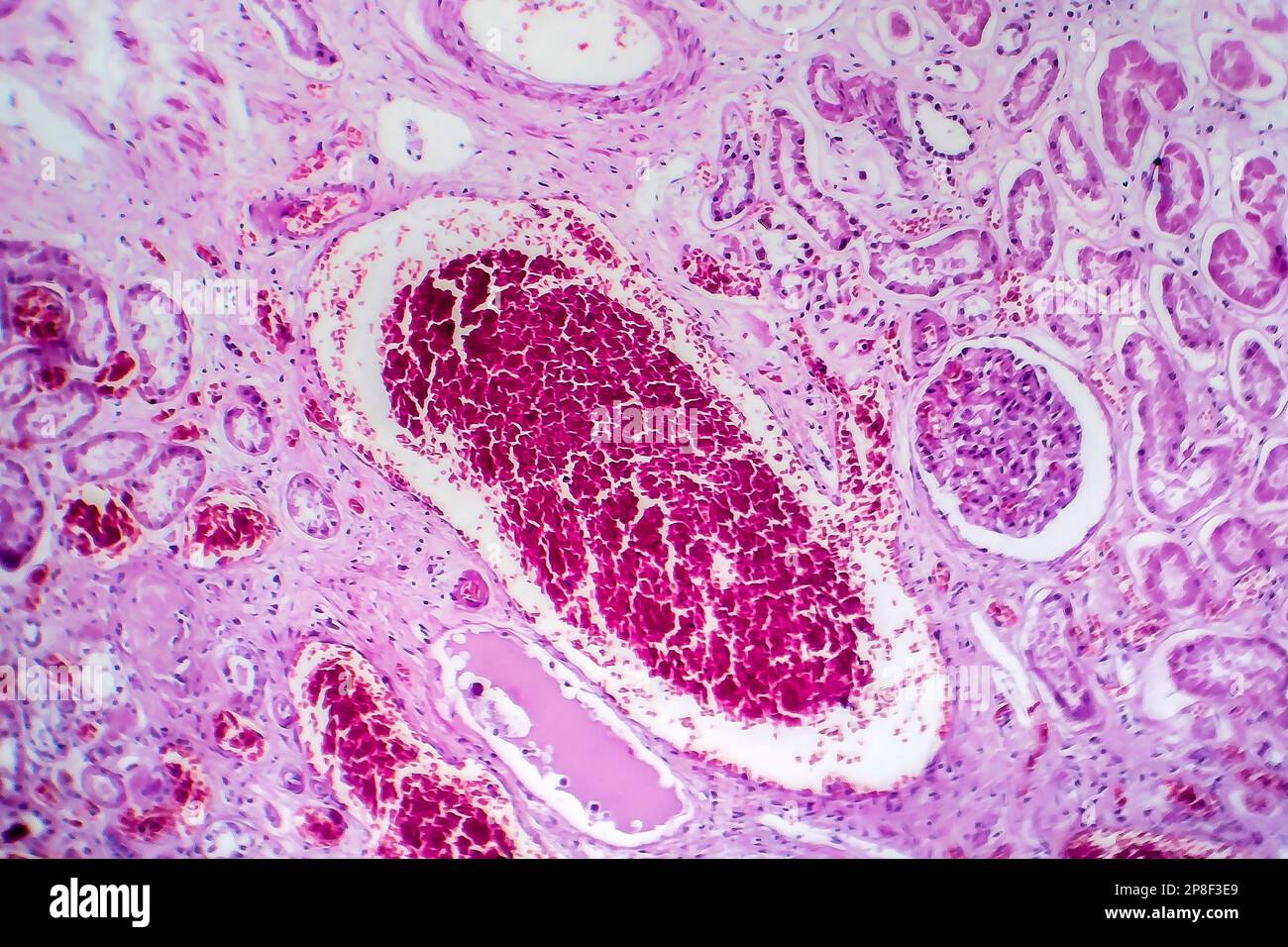 Acute glomerulonephritis hi-res stock photography and images - Alamy