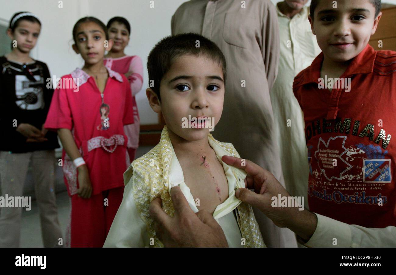 An Iraqi child Awss Asmat, 4, shows the mark on his chest from a heart ...