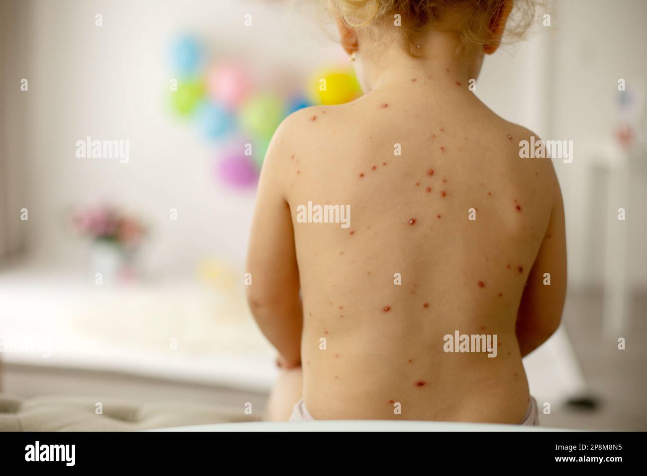 Little toddler girl with chickenpox in bed, playing at home, quarantine ...