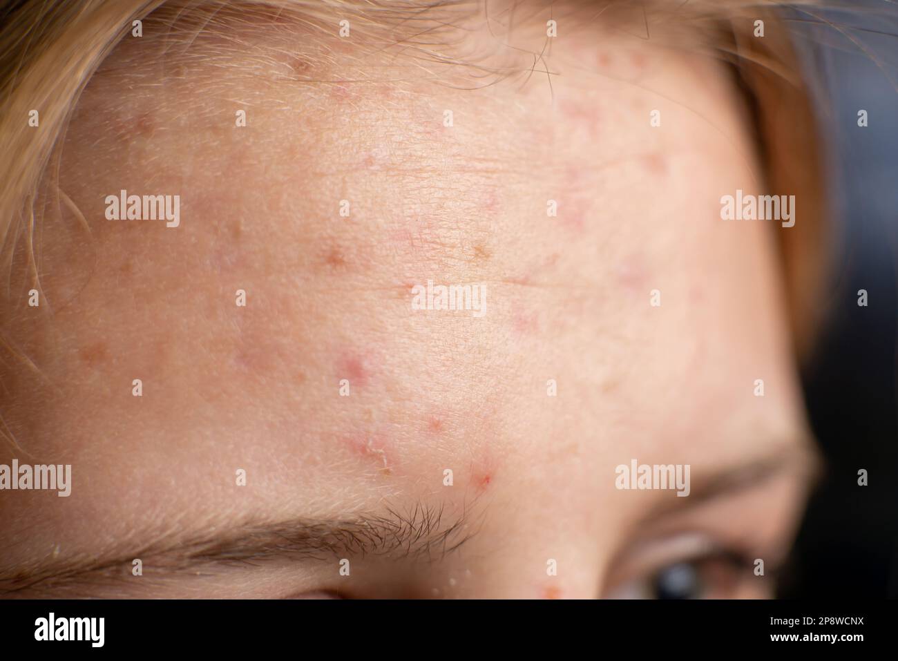 Pimples on forehead of teenager girl. Close-up of skin with ...