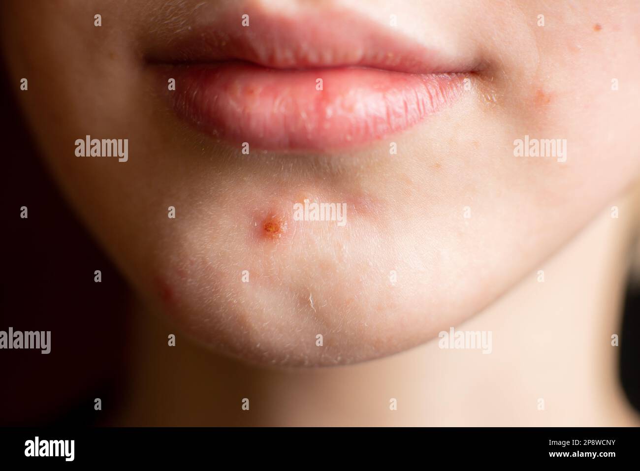 Adolescence disease hi-res stock photography and images - Alamy