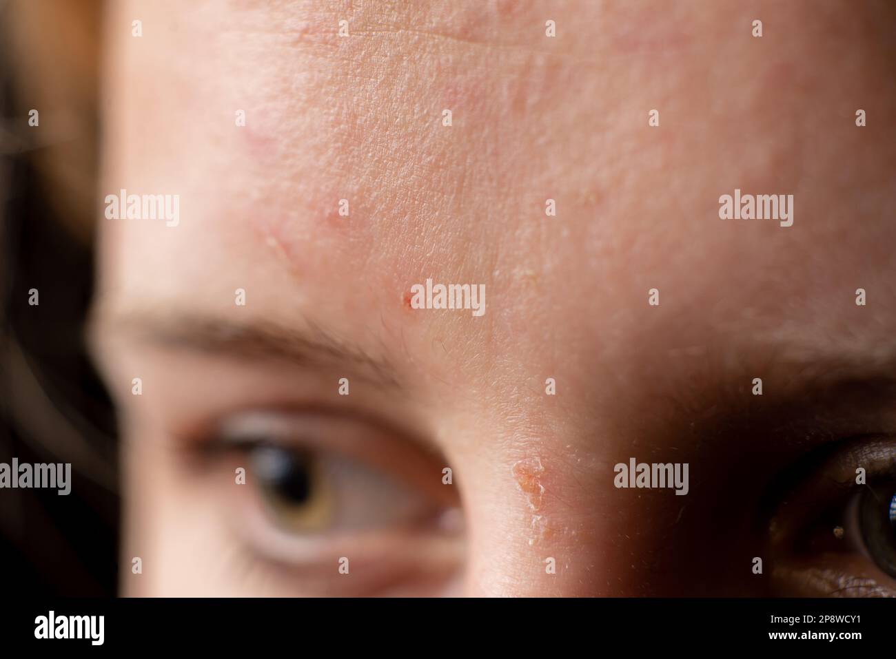 Pimples on forehead of teenager girl. Close-up of skin with ...