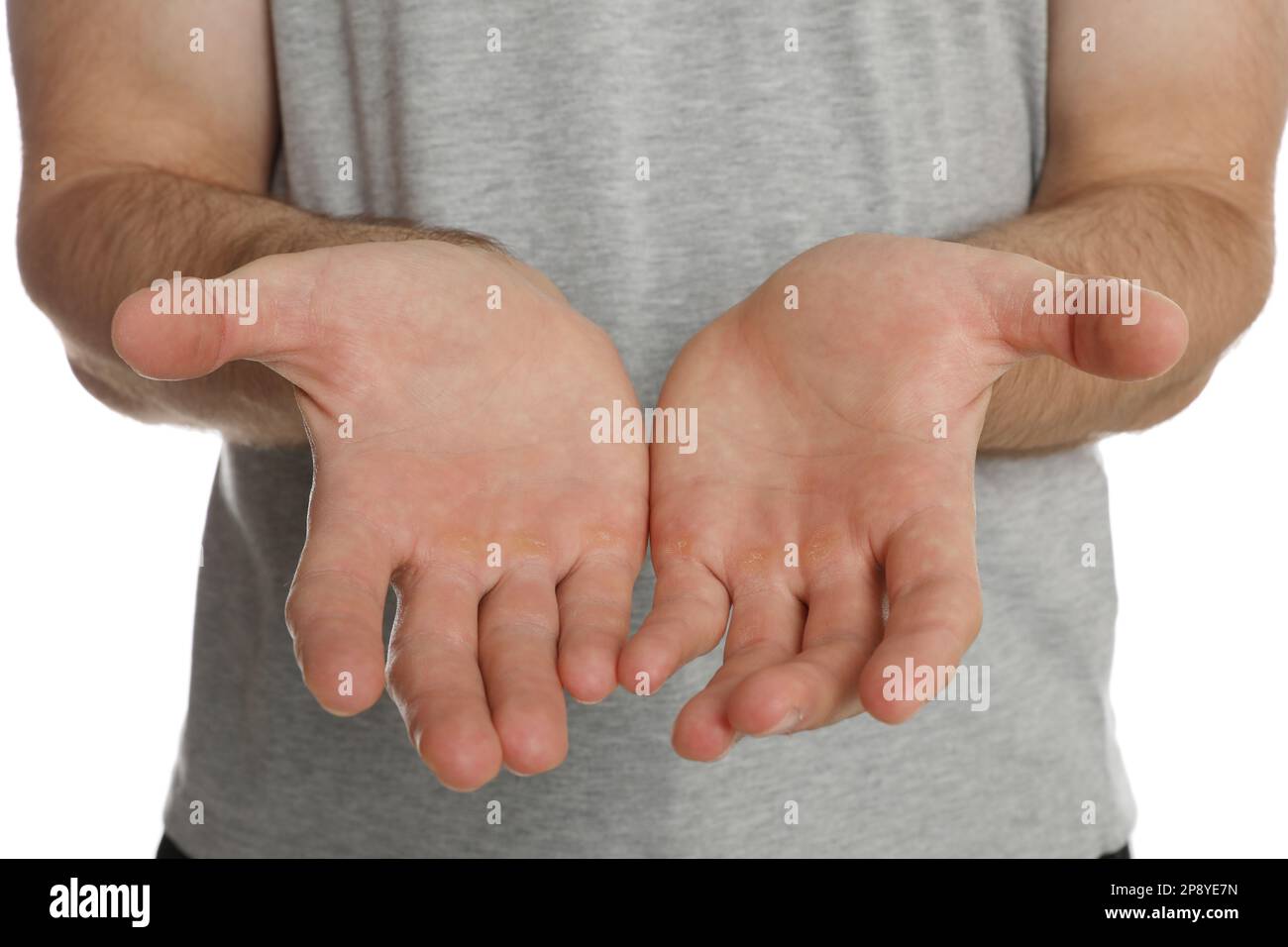 Man suffering from calluses on hands against white background, closeup ...