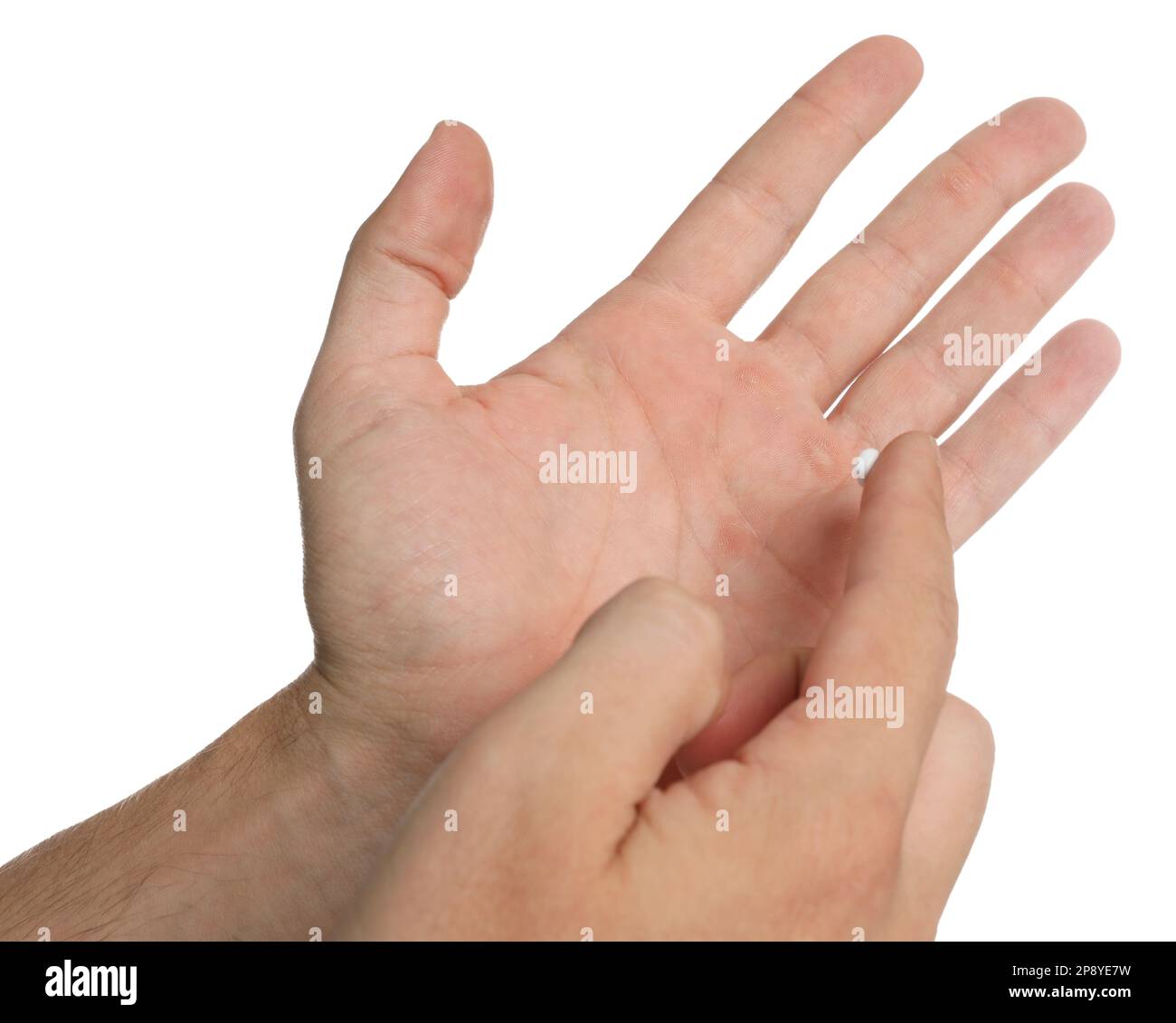 Man applying cream on hand for calluses treatment against white ...