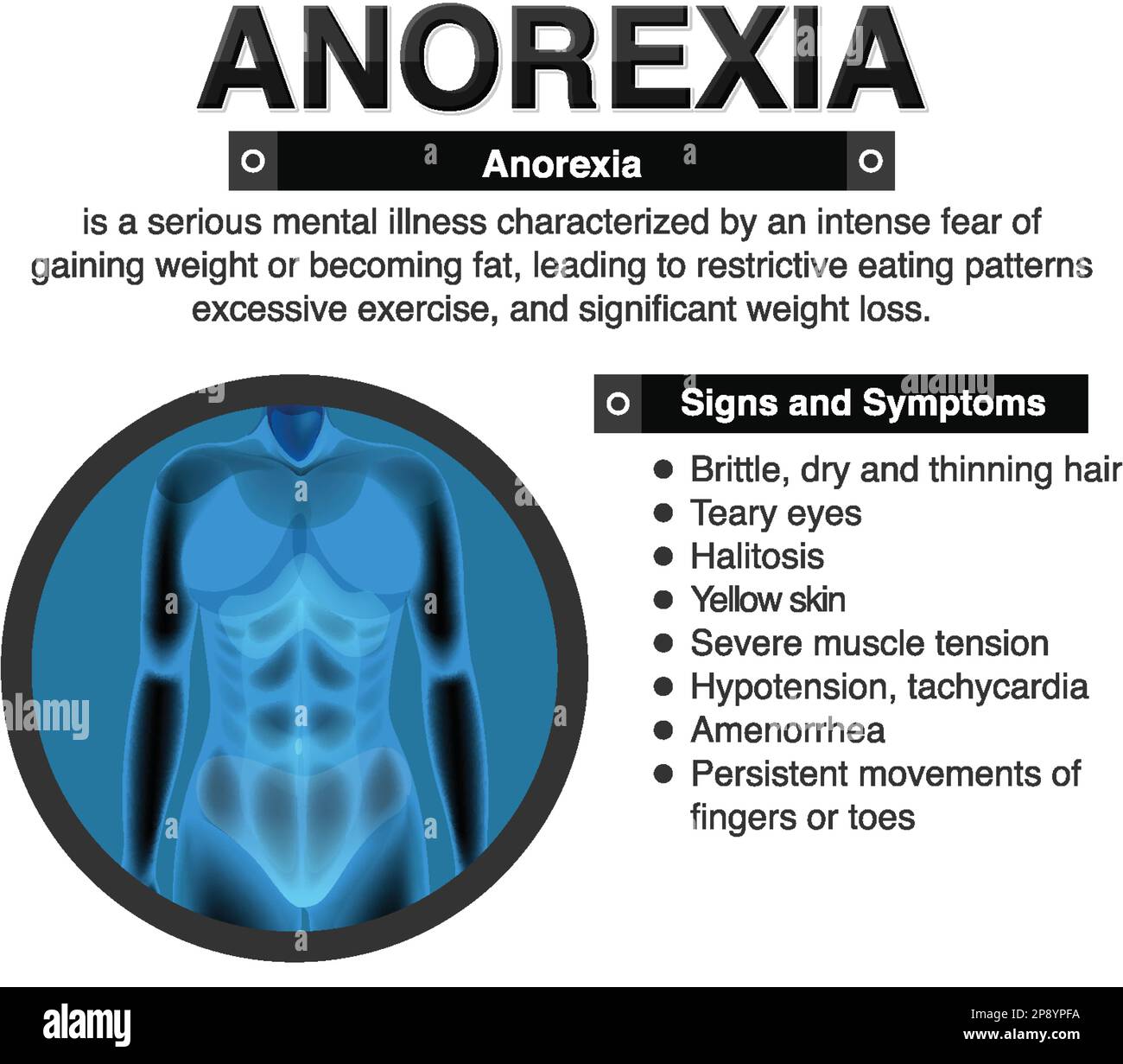 Anorexia (Anorexia) and Its Effects on the Body illustration Stock ...