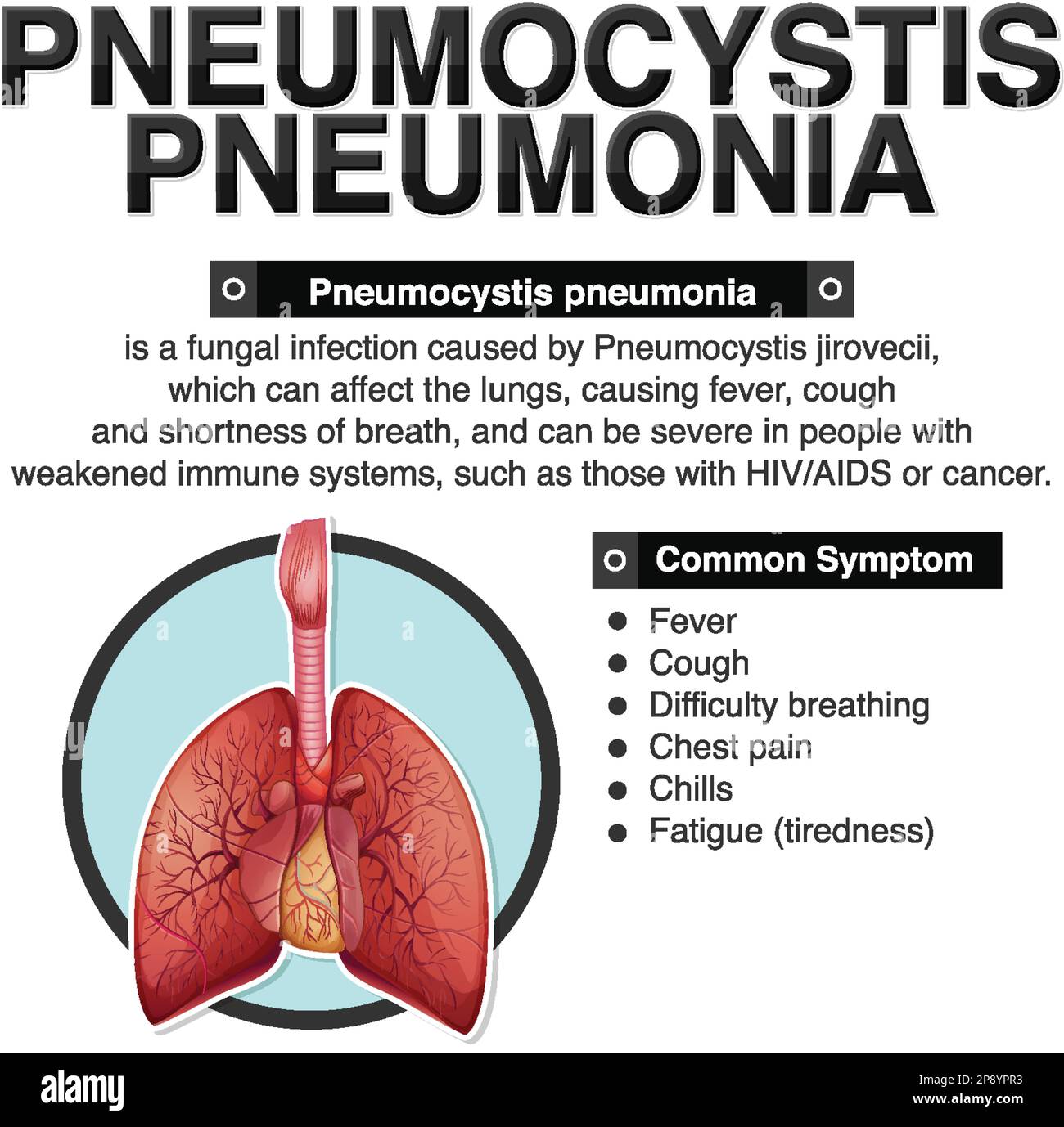 Informative poster of Pneumocystis Pneumonia illustration Stock Vector ...