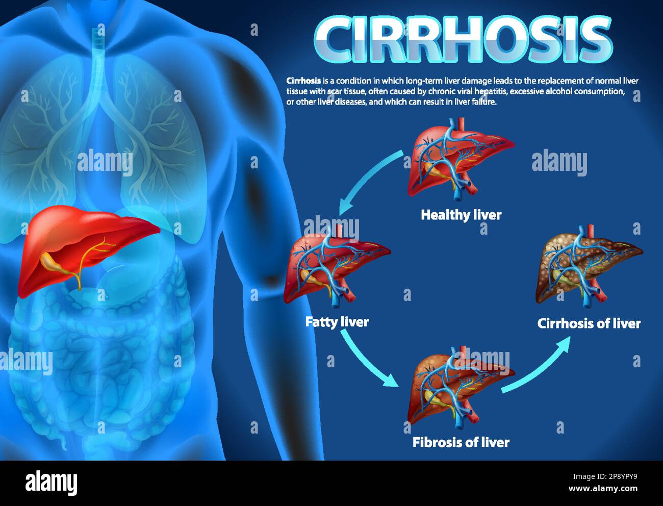 Informative Poster Of Alcoholic Liver Disease Cirrhosis Illustration Stock Vector Image And Art