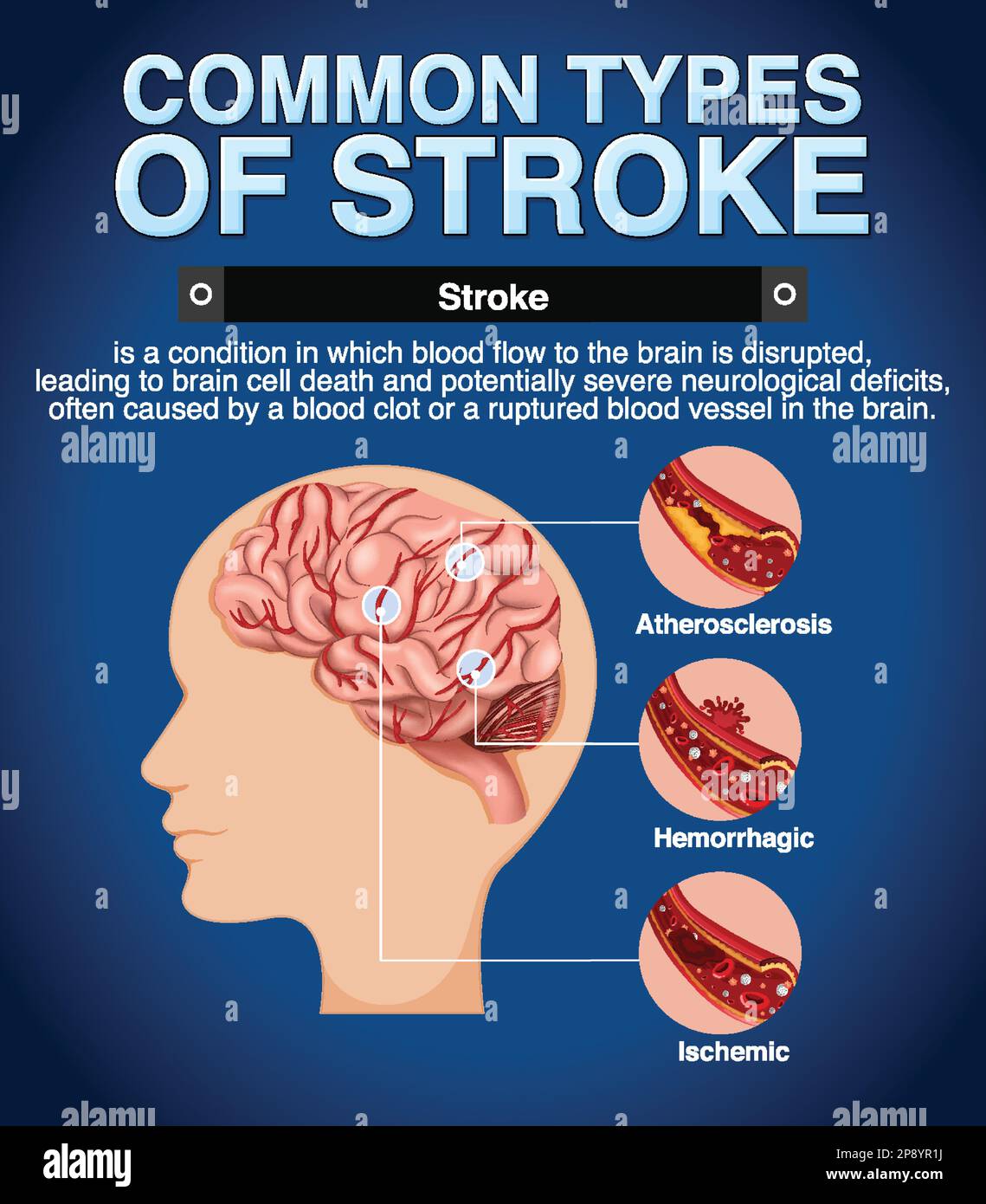 Informative poster of common types of stoke illustration Stock Vector ...