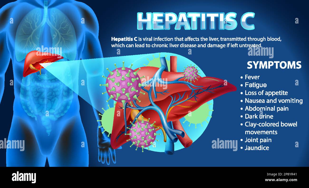 Informative Symptoms of Hepatitis C illustration Stock Vector Image ...