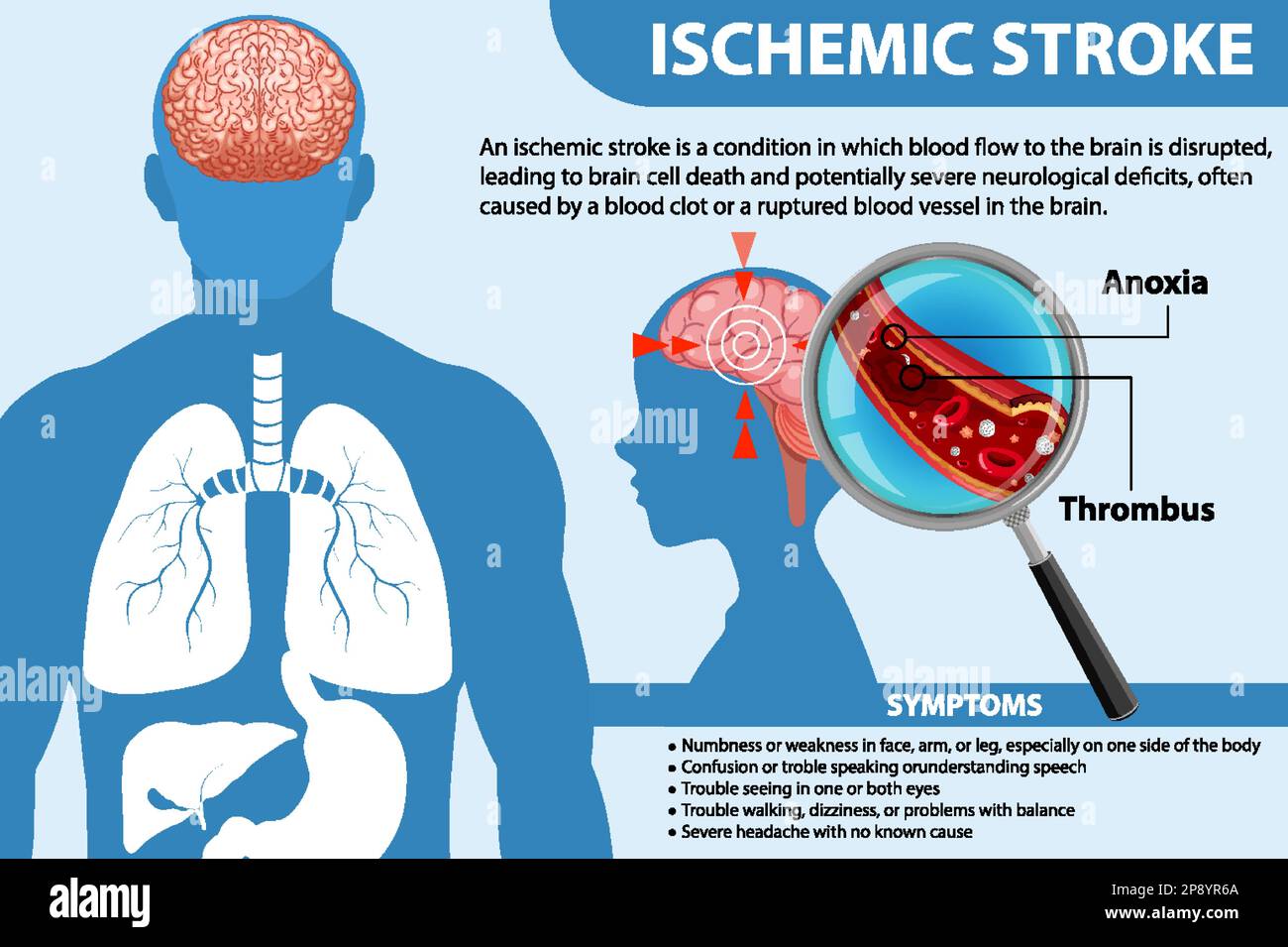 Informative poster of Ischemic stroke illustration Stock Vector Image ...