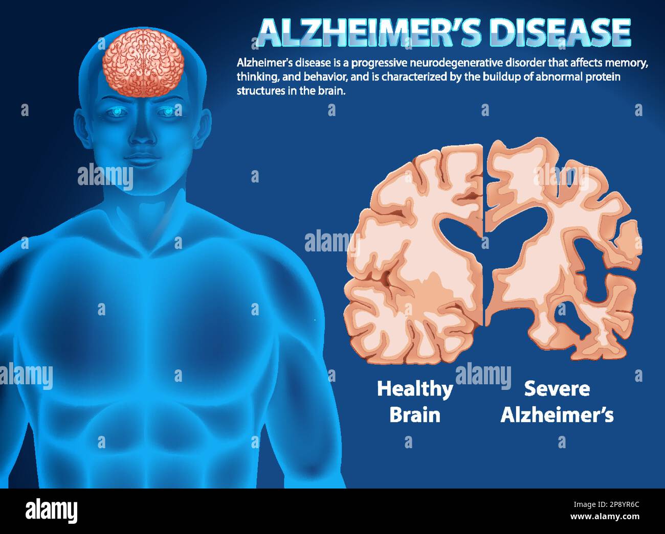Informative poster of Alzheimers disease illustration Stock Vector ...