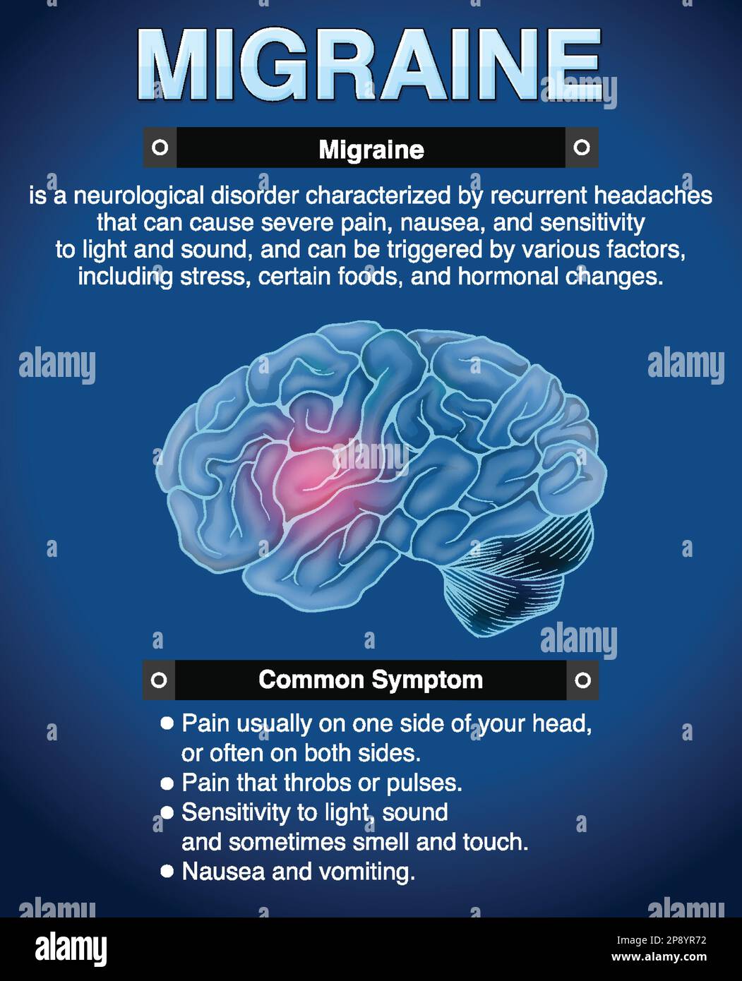 Informative poster of Migraine illustration Stock Vector Image & Art ...