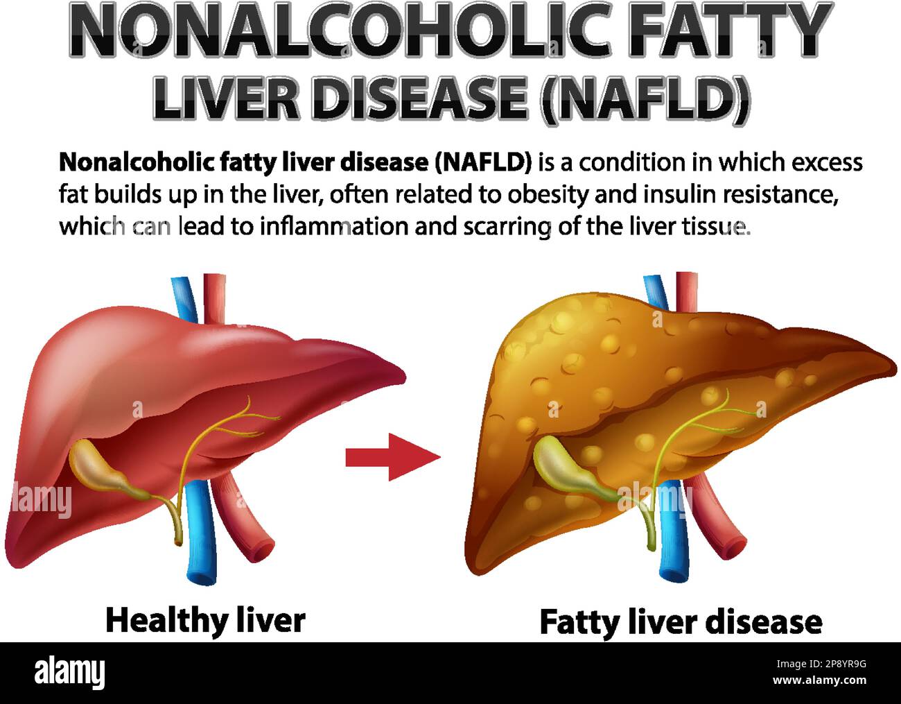 Nonalcoholic Fatty Liver Disease illustration Stock Vector Image & Art ...
