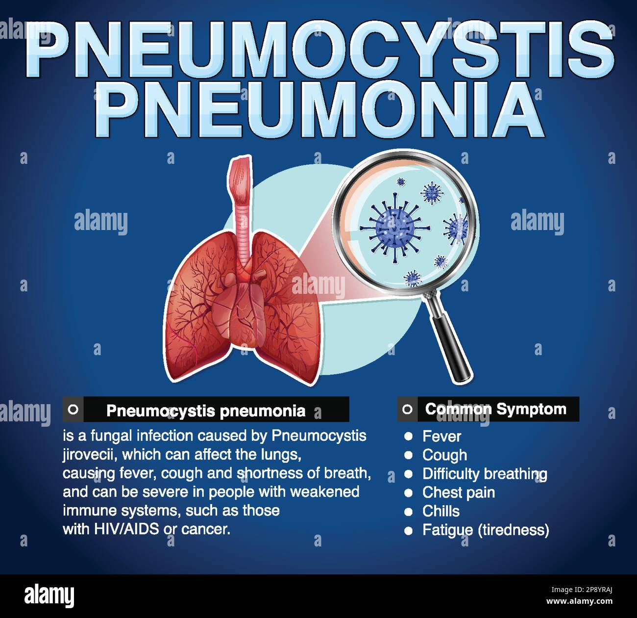 Informative poster of Pneumocystis Pneumonia illustration Stock Vector ...