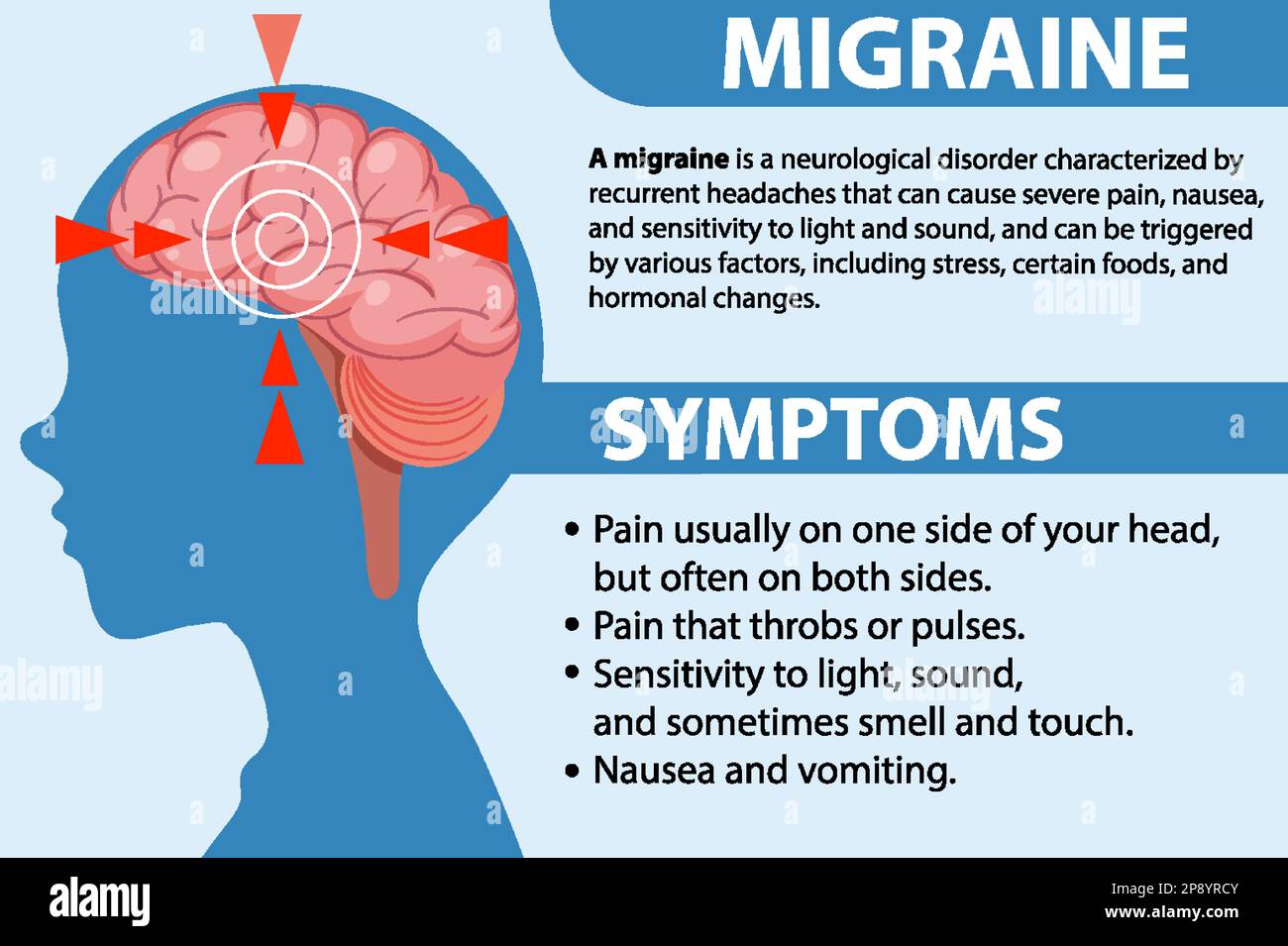 Informative poster of Migraine illustration Stock Vector Image & Art ...