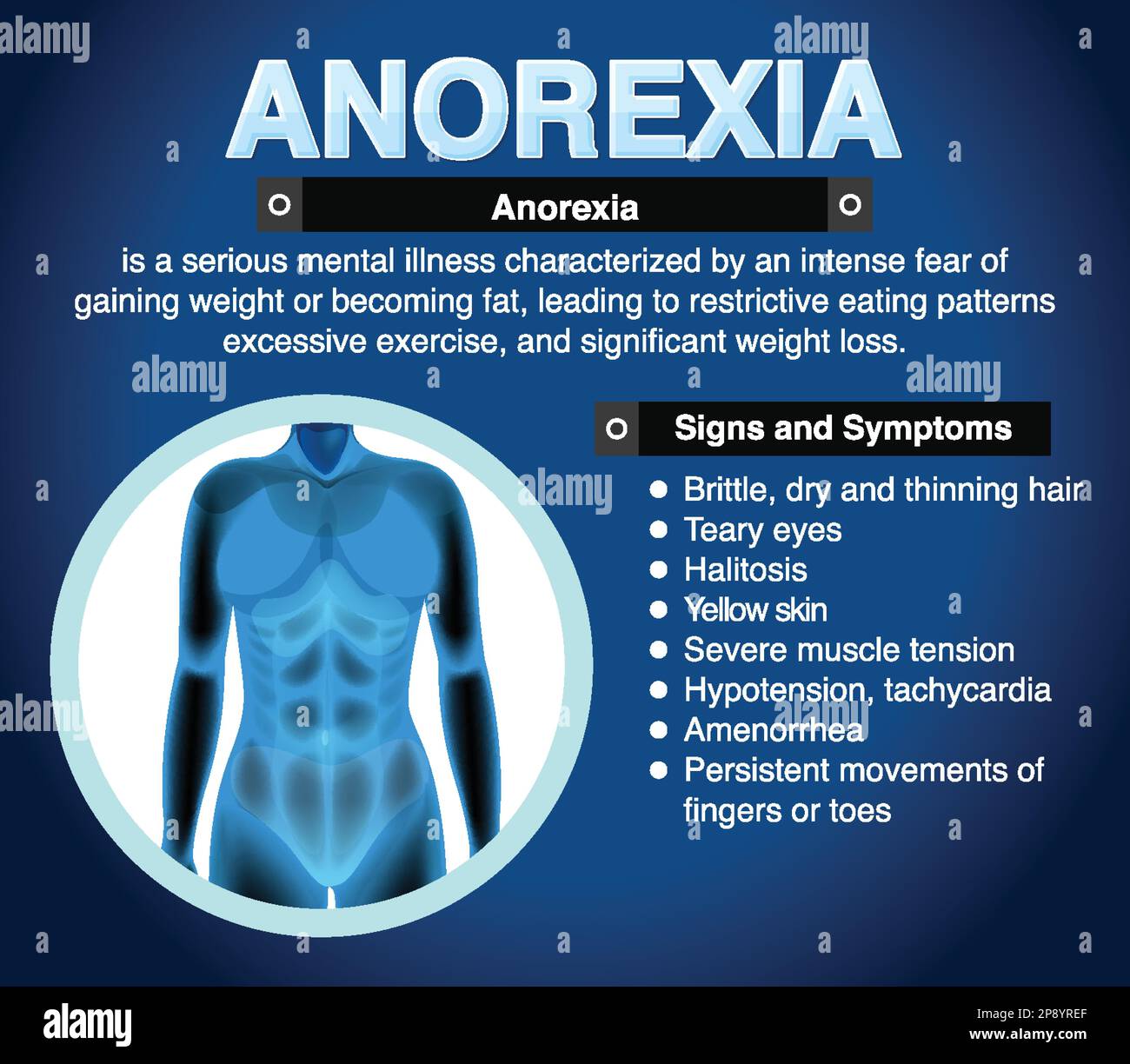 Informative poster of Anorexia eating disorder illustration Stock ...
