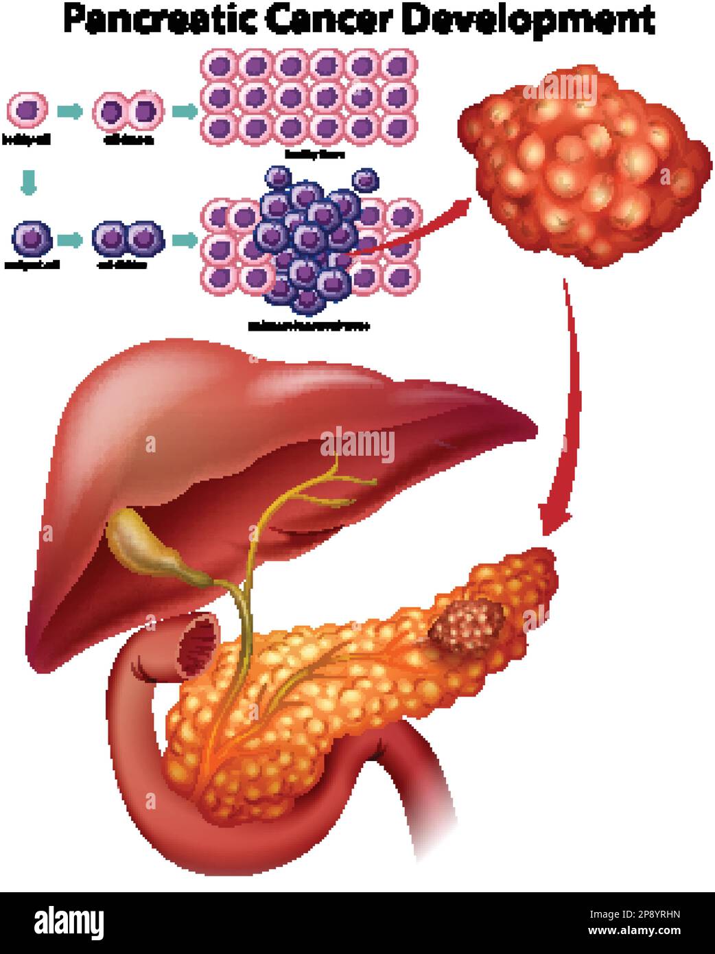 Pancreatic Cancer Development Infographic Illustration Stock Vector Image And Art Alamy