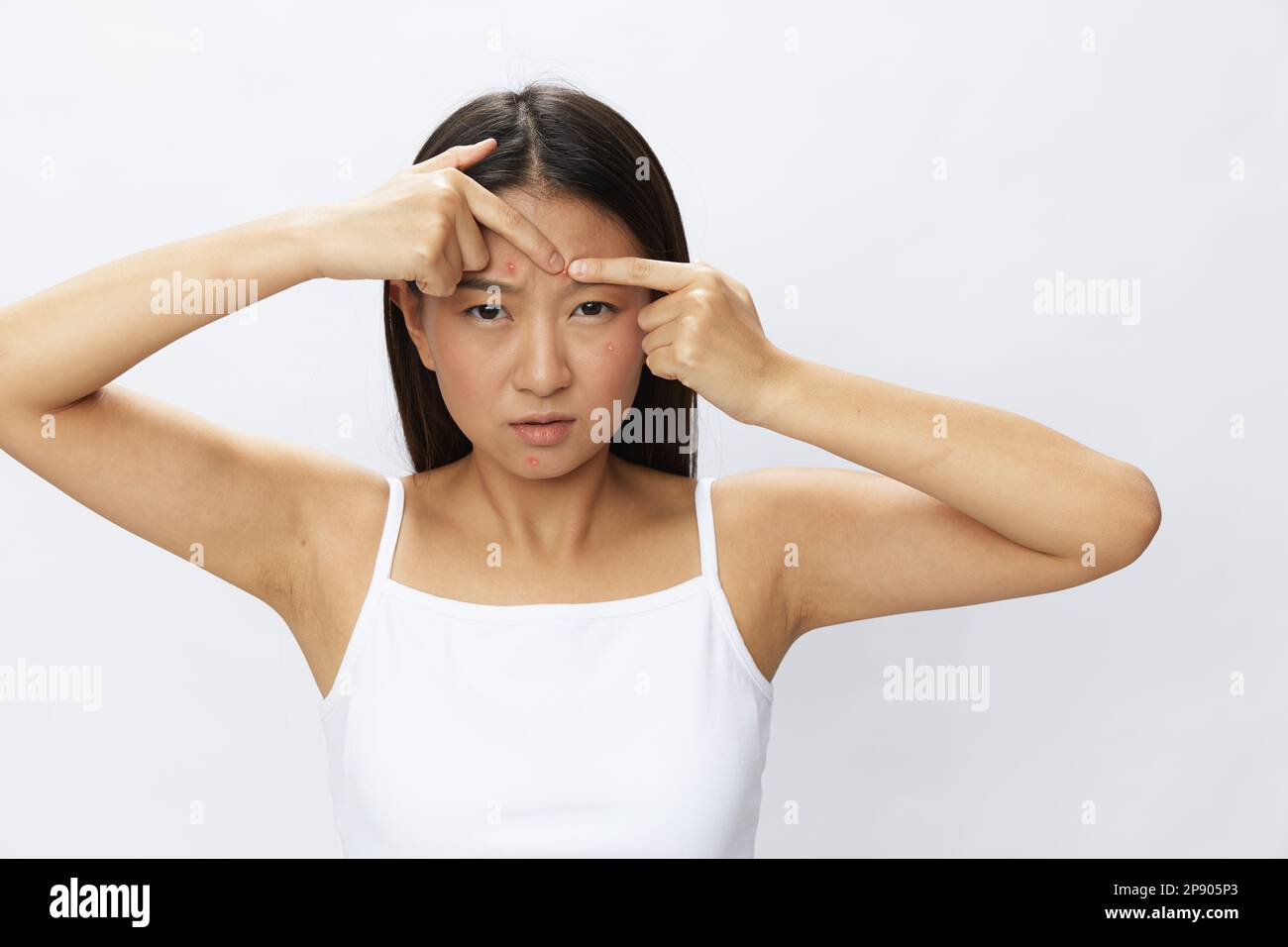 Asian woman facial skin problems, acne and inflammation, red rashes and ...