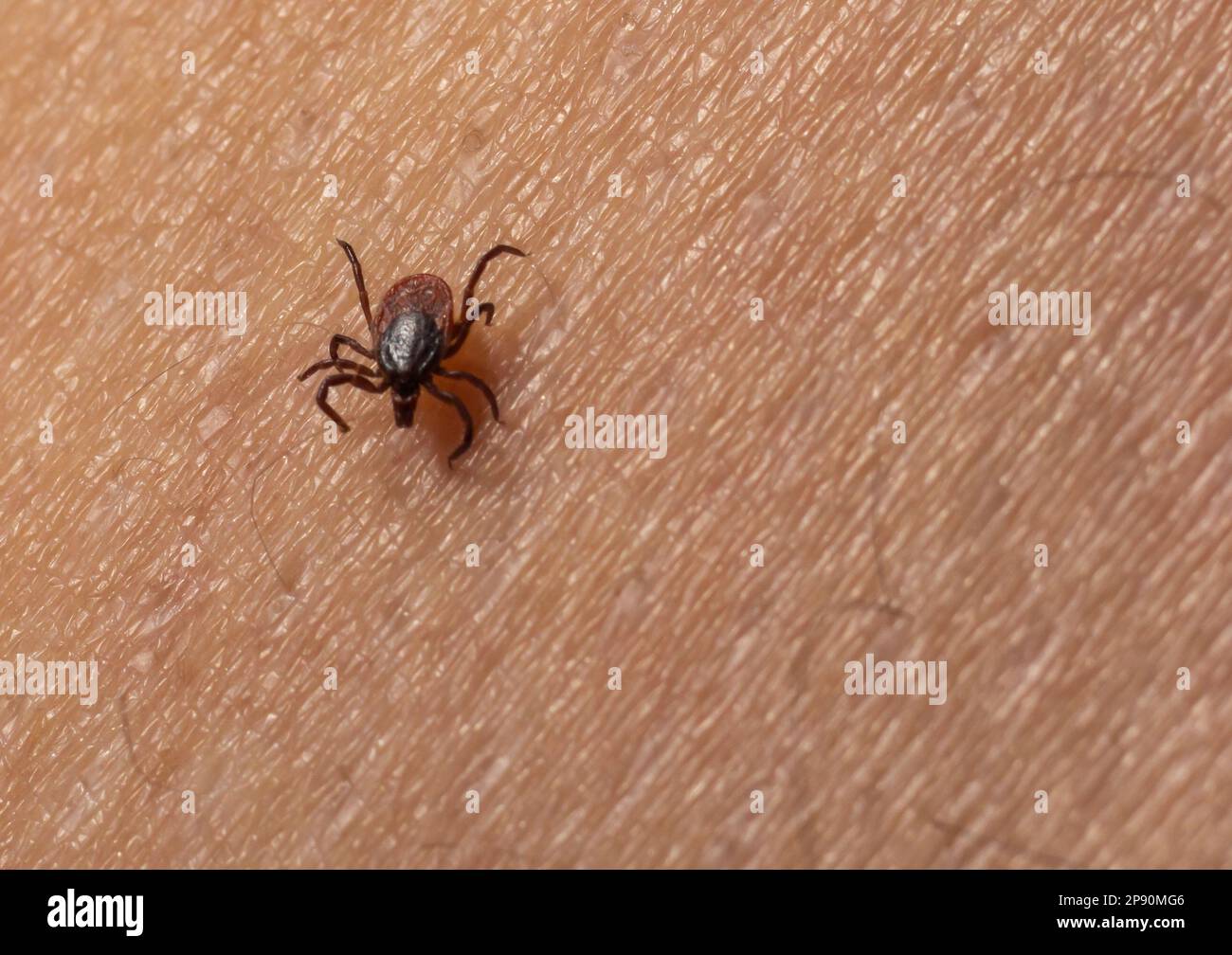 Infected female deer tick on hairy human skin. Ixodes ricinus. Parasitic mite. Acarus. Dangerous ...