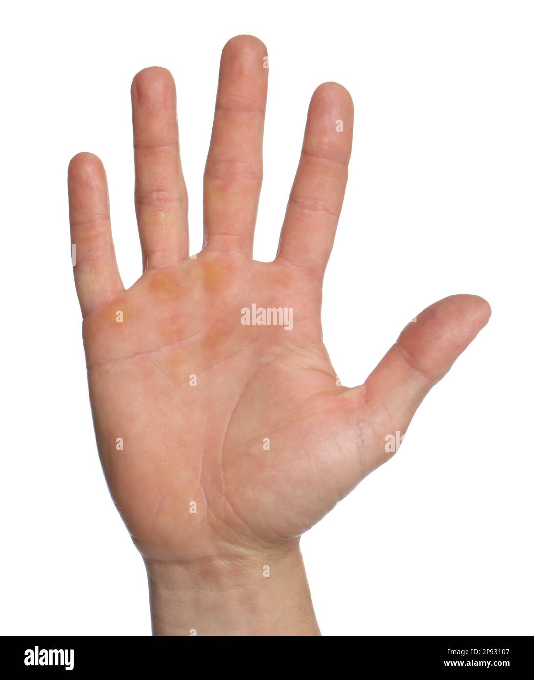 Man suffering from calluses on hand against white background, closeup ...
