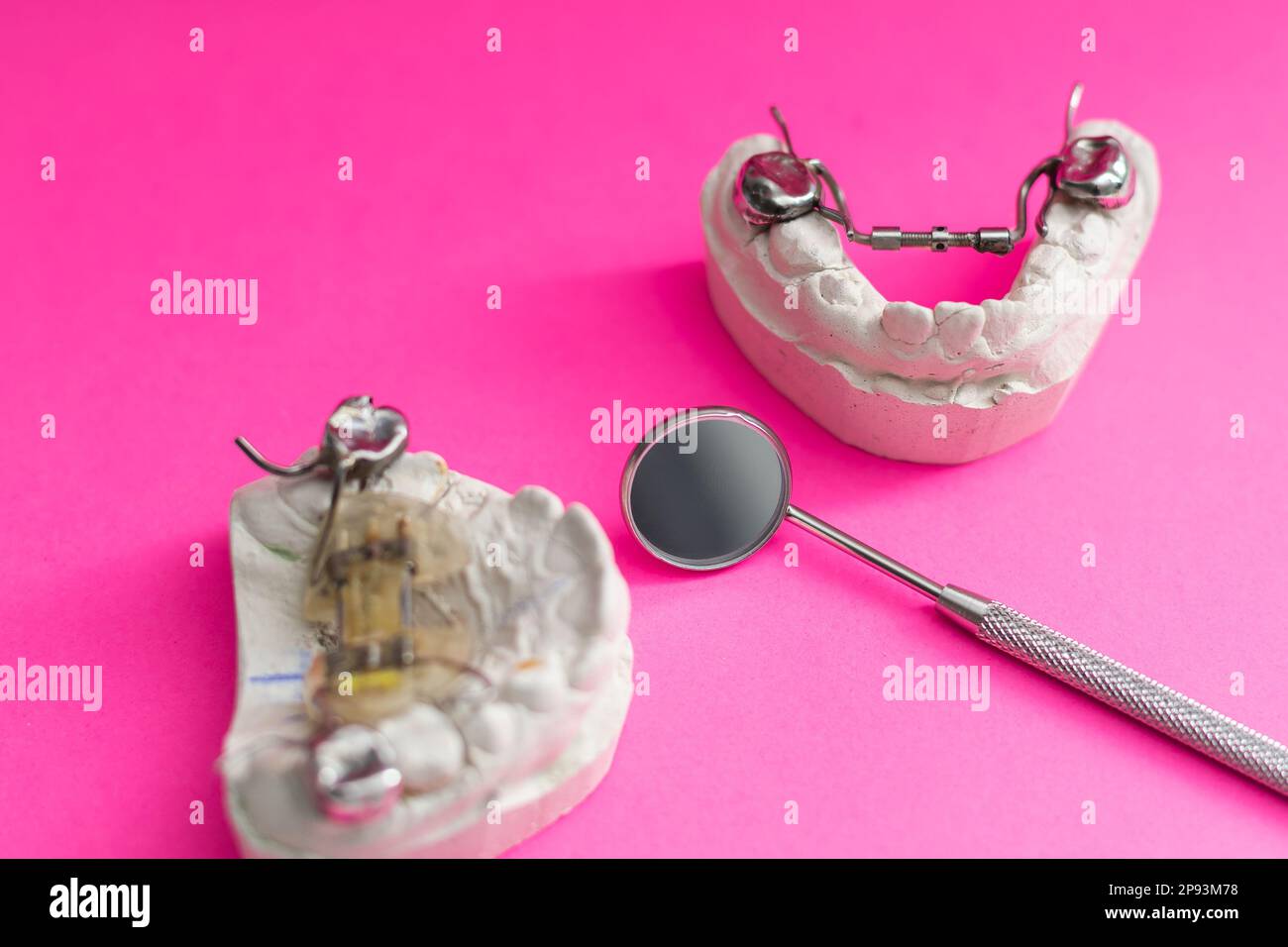 Dental casting gypsum model of human jaws. Crooked teeth and distal ...