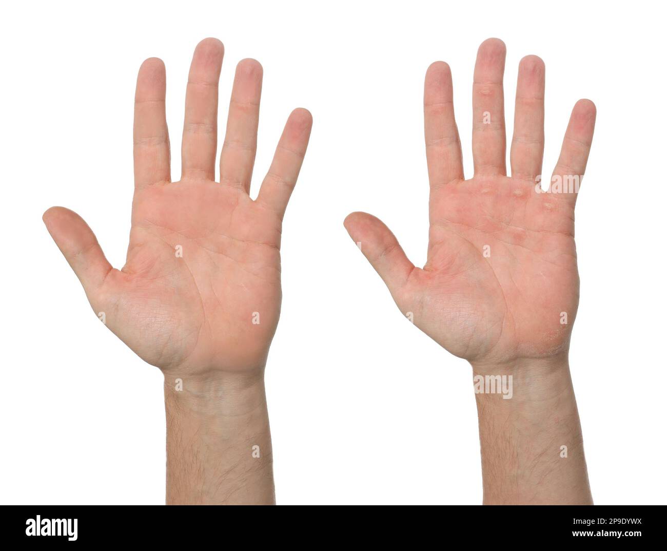 Man showing hands without and with calluses on white background ...