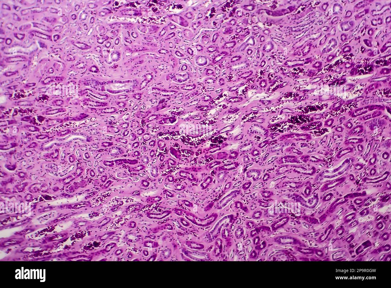 Diffuse Proliferative Glomerulonephritis Em