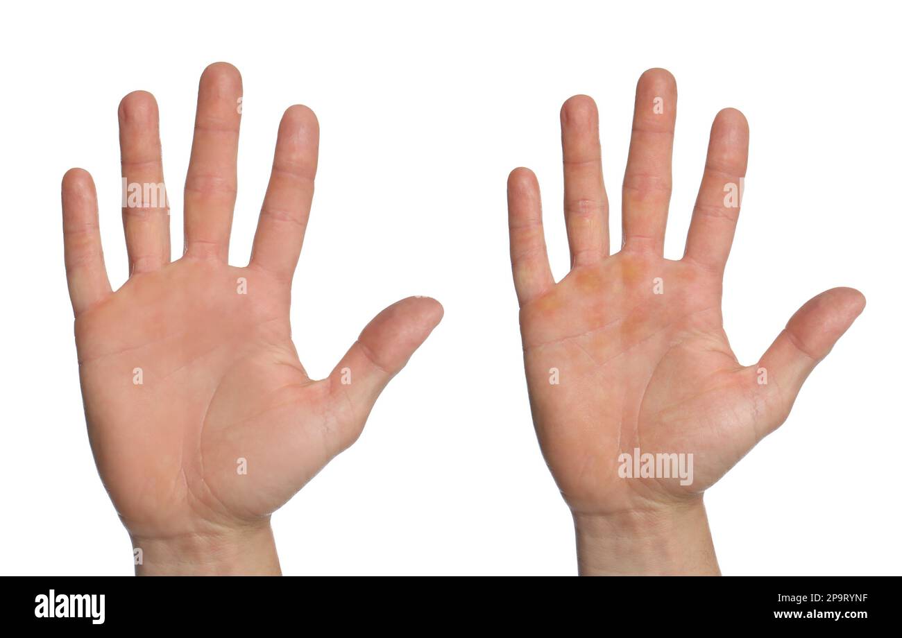 Man showing hands without and with calluses on white background ...