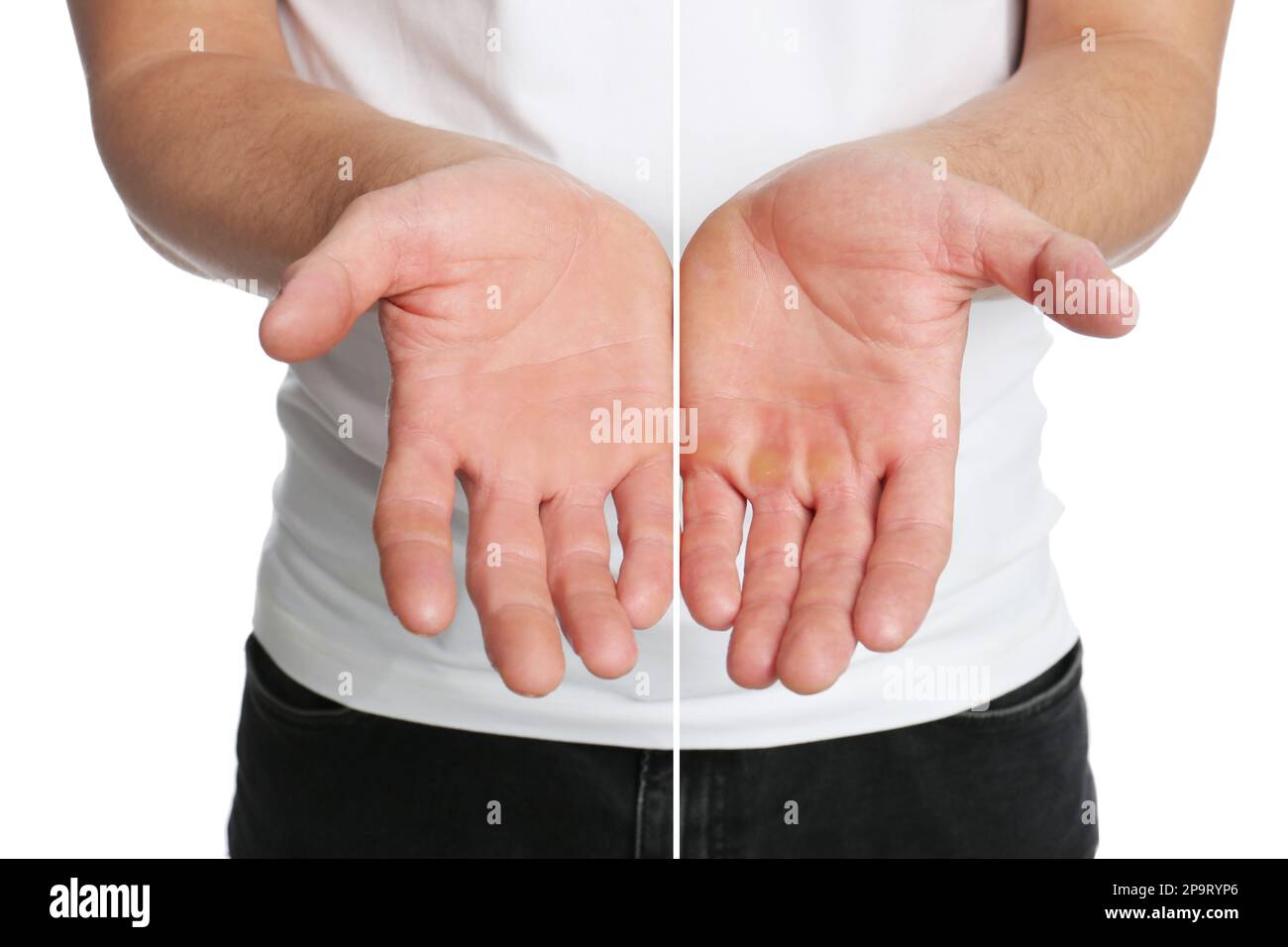 Man showing hands without and with calluses on white background ...