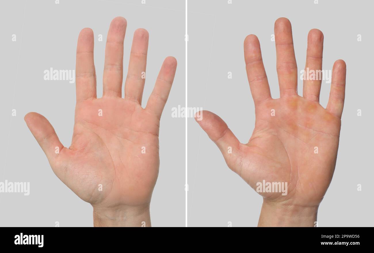 Man showing hands without and with calluses on light grey background ...