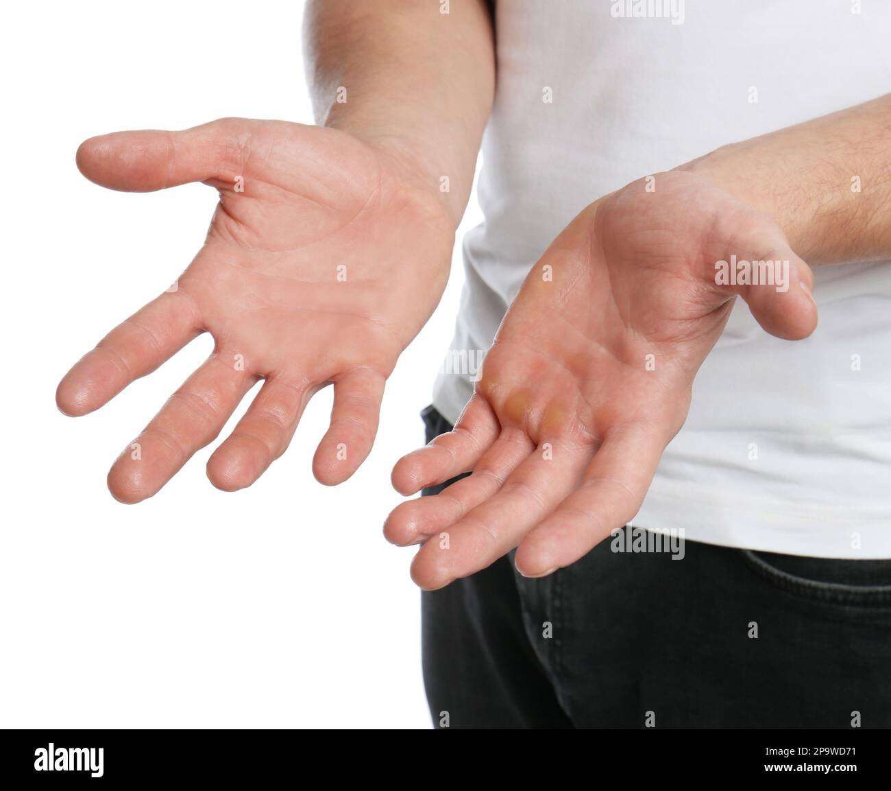 Man showing hands without and with calluses on white background ...