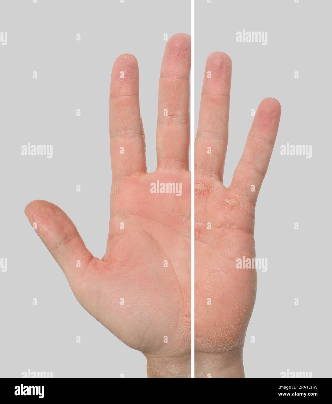 Man showing hand without and with calluses on light grey background ...