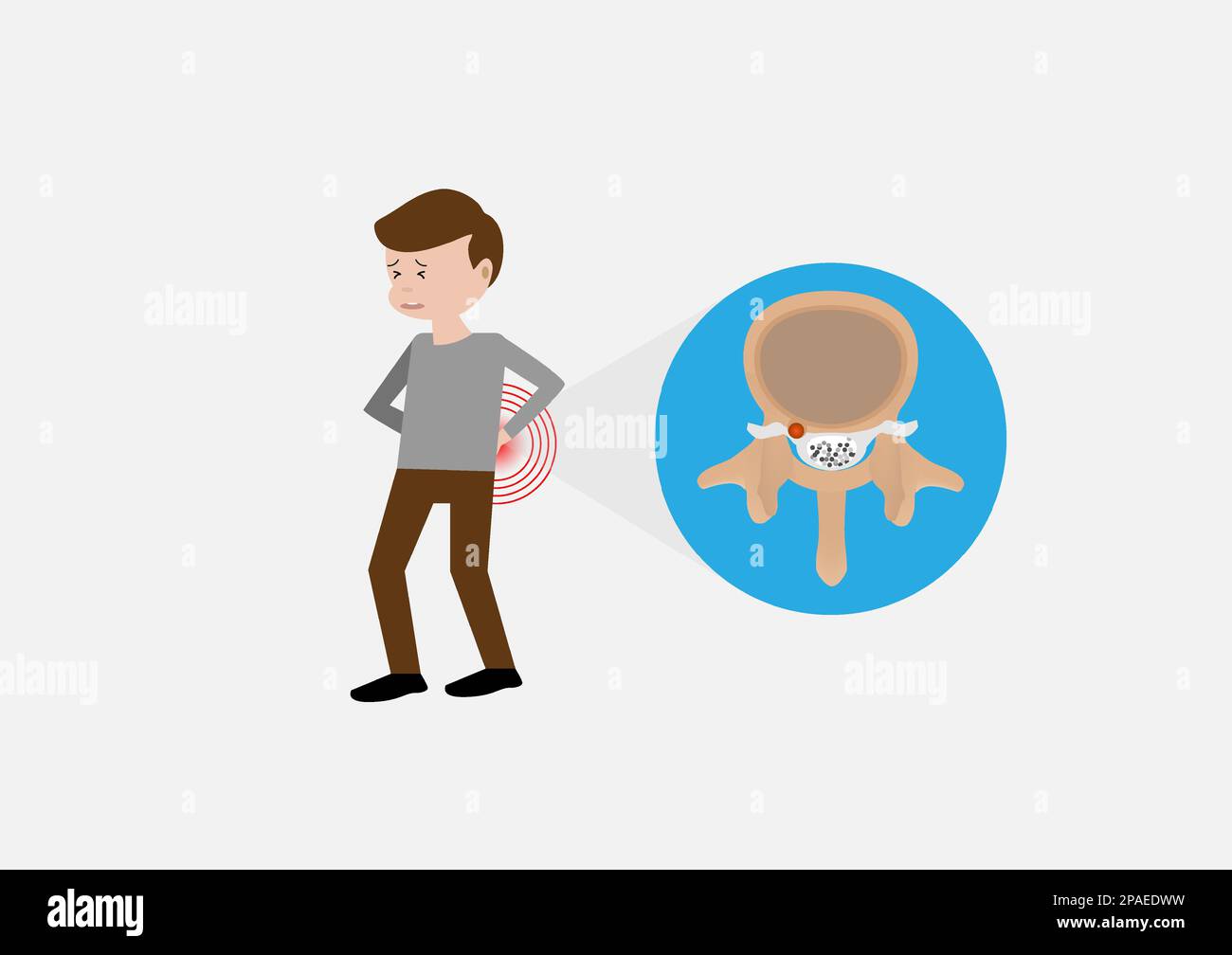 Lumbar Disc Herniation In Young Adults at Lisa Leach blog