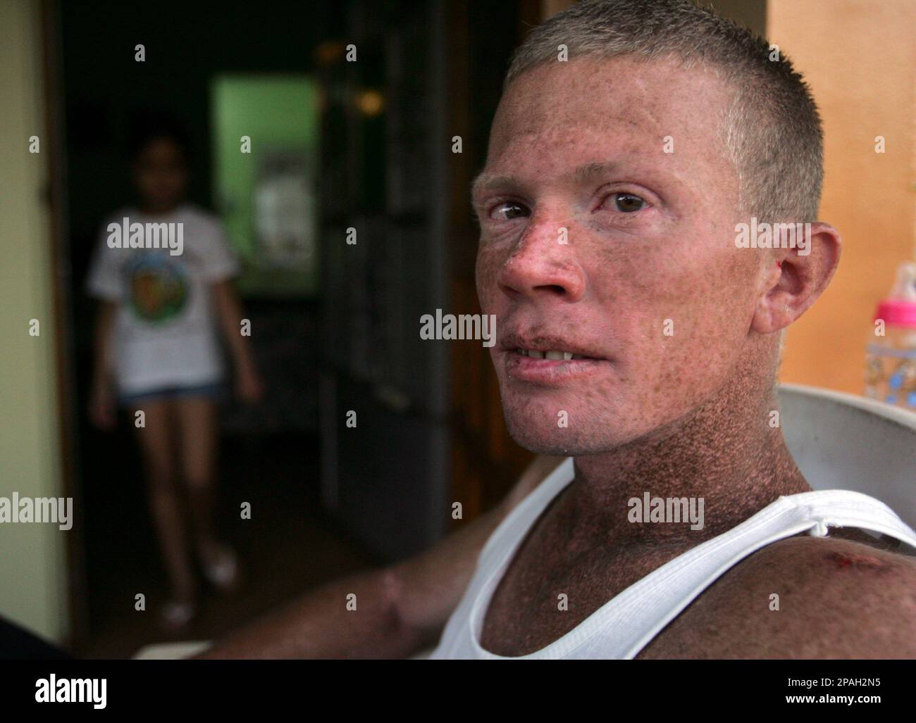 Puerto Rican Alejandro Nieve, 25, who suffers from albinism, sits on ...