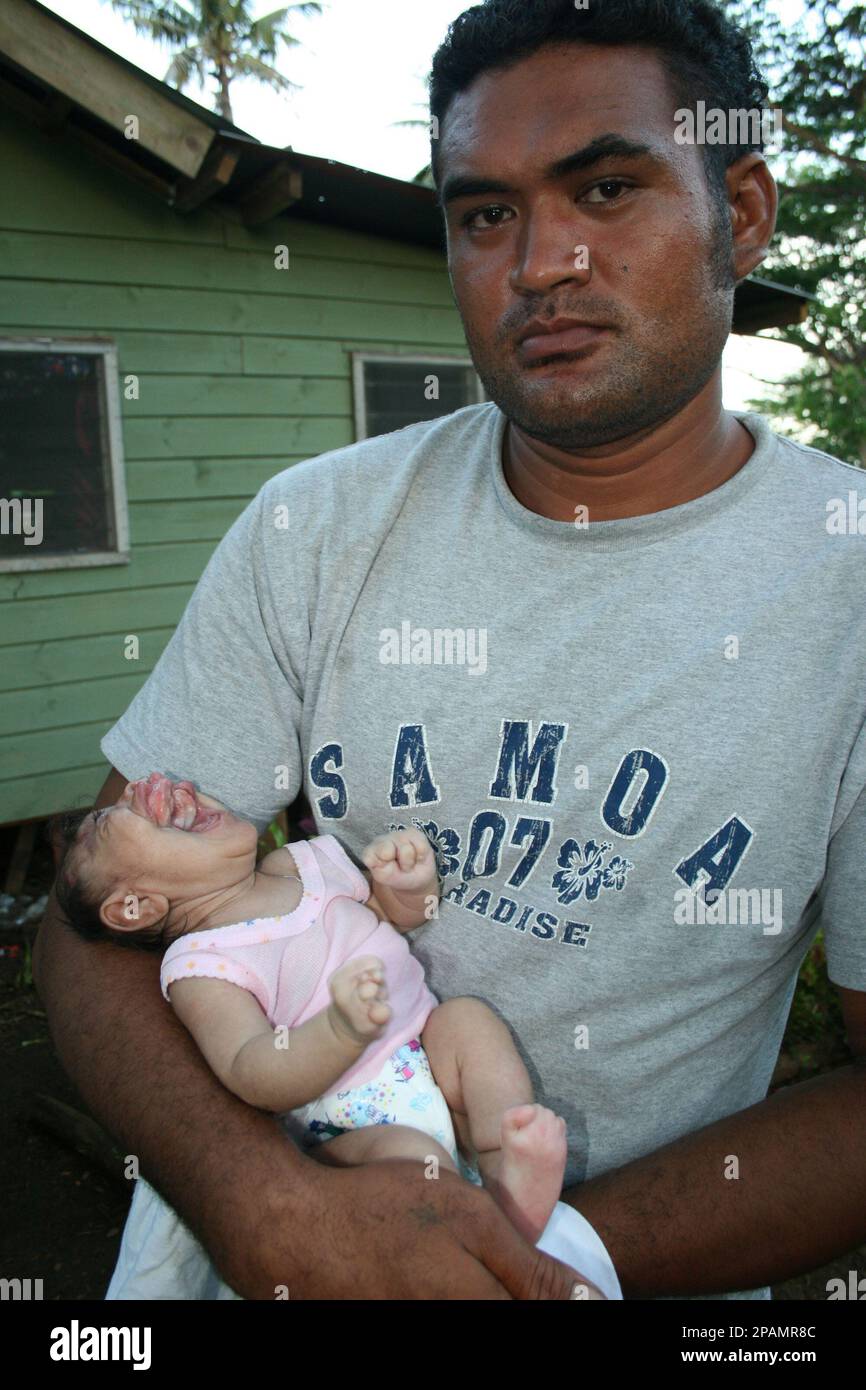 Sefulu Nanai holds his deformed four-month-old daughter Miracletina, in ...