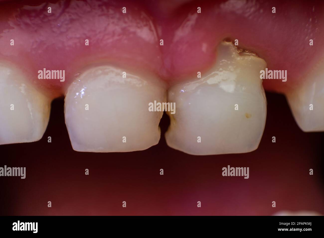 Child incisor teeth hi-res stock photography and images - Alamy