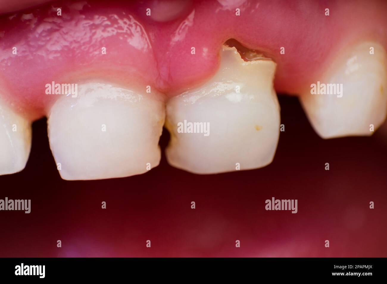 close-up picture of an incisor tooth that is about to erupt in a 7-year ...