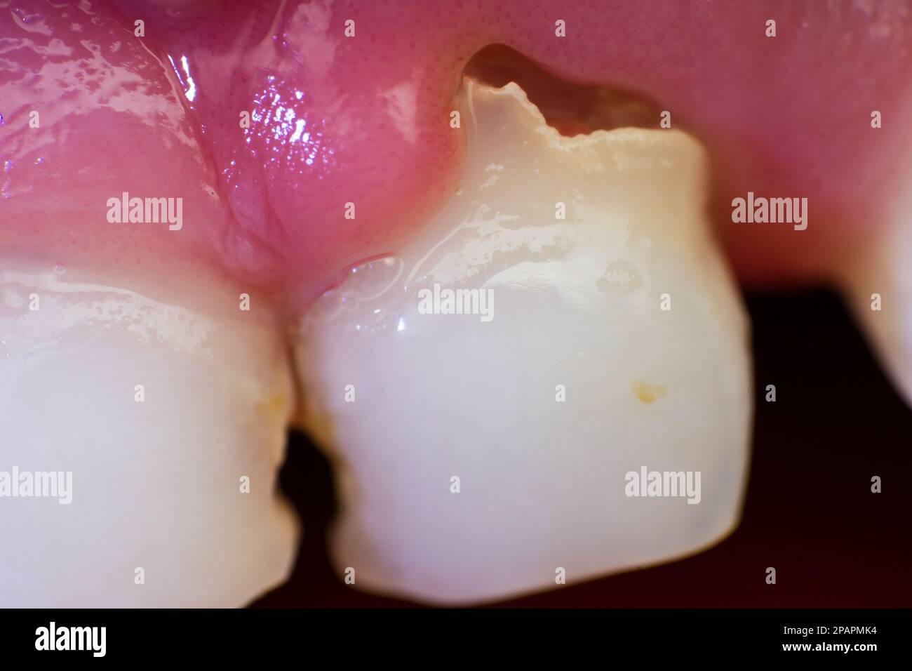close-up photo of a incisor tooth broken of a 7 years old child Stock ...