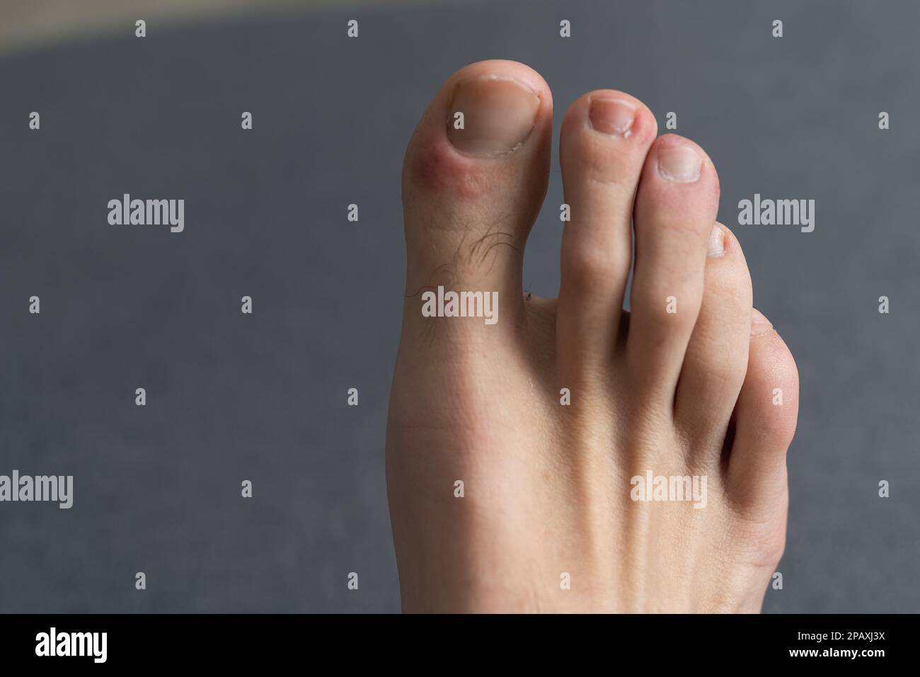 hair and pimples on men's toes Stock Photo - Alamy