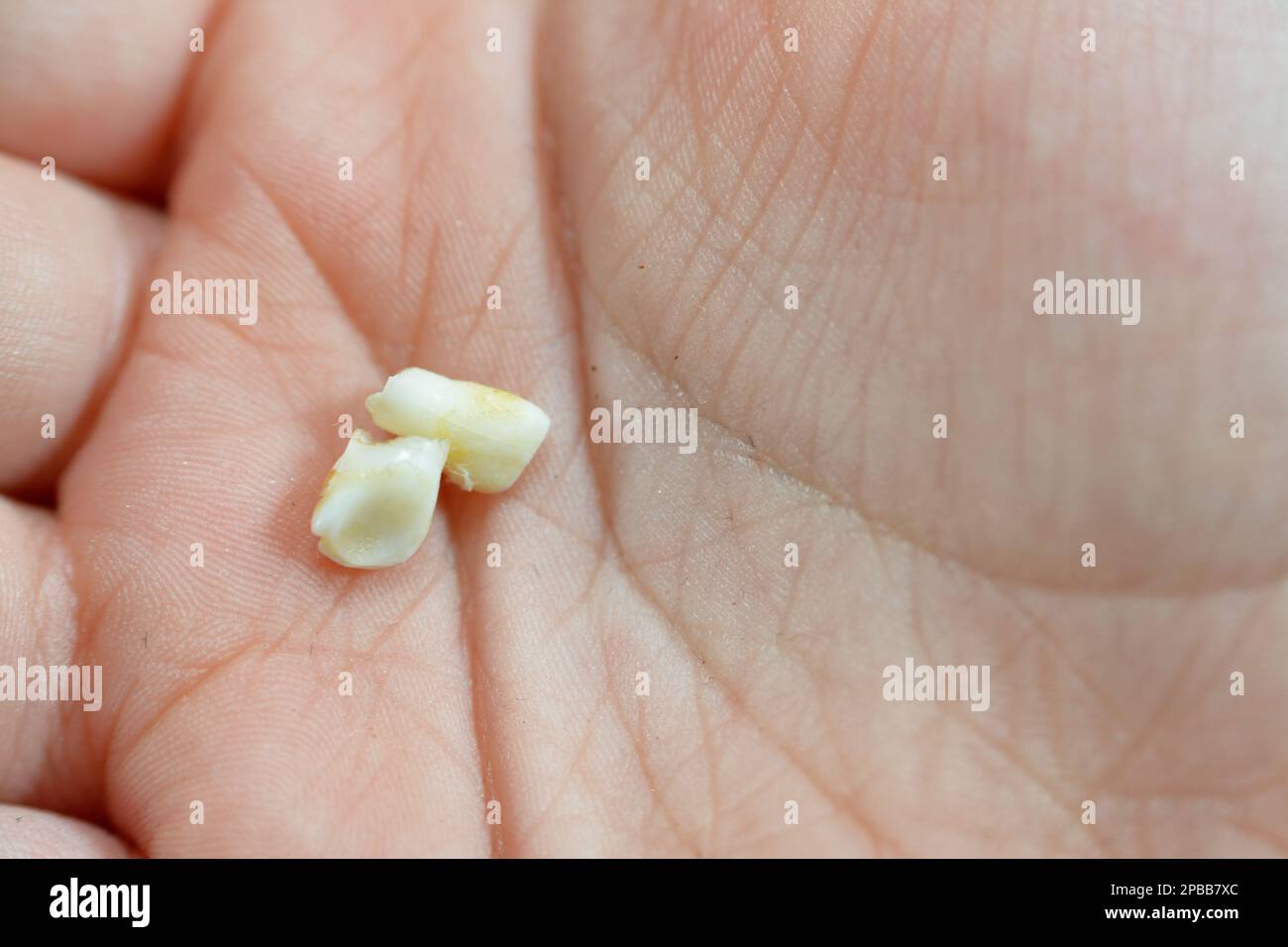 Deciduous primary baby temporary teeth, the first set of teeth in the ...