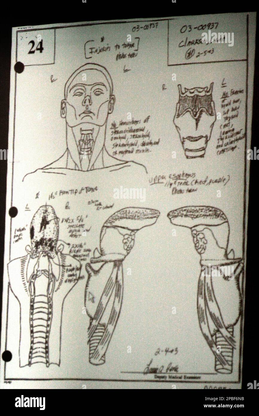 An autopsy drawing of the head and tongue of actress Lana Clarkson ...